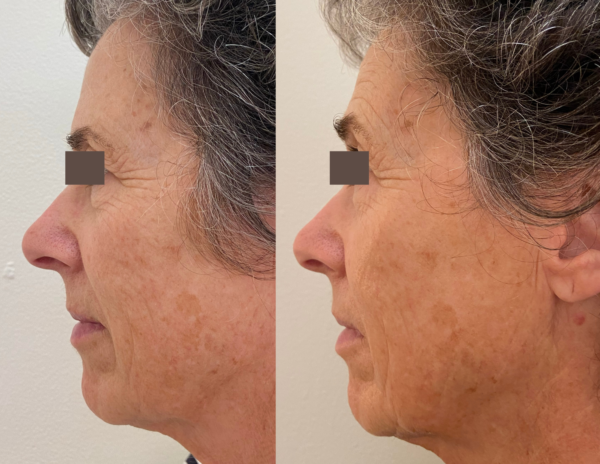 New Cosmetic Acupuncture Before and After Photos - Seneca Falls Acupuncture